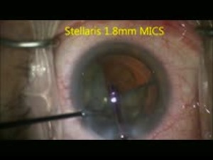 My First Use of the BLIS (Bausch + Lomb Injection System) Injector for ...