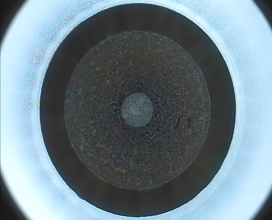 My First SMILE Case - Eyetube