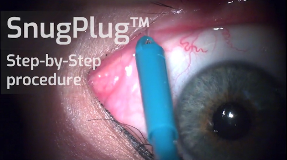 SnugPlug™ | USA | Permanent Punctum Plug | Step-by-step Procedure - Eyetube