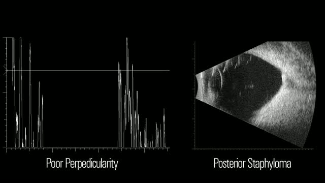 Performing A-Scan Biometry with Quantel Ultrasound Systems - Eyetube