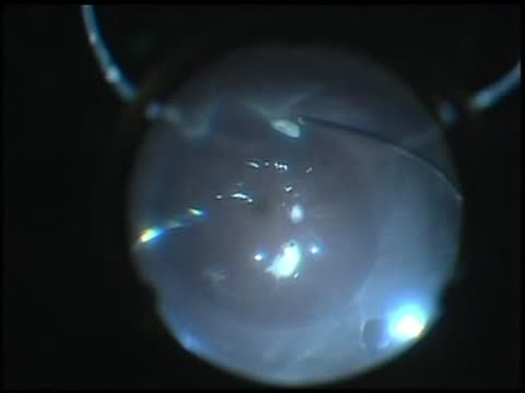 Lens Fragment Removal with 27-Gauge Instruments - Eyetube
