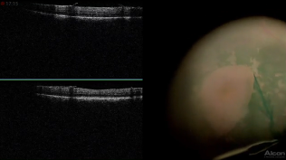Intraoperative OCT in Vitreomacular Traction Syndrome - Eyetube