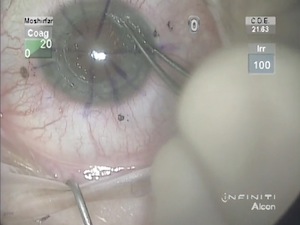 Wound Revision and Compression Sutures for Treatment of Post PKP ...