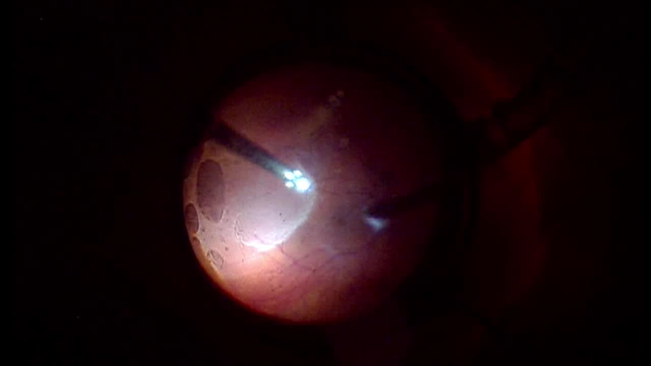 Retinoschisis With Unseen Outer Retinal Break - Eyetube