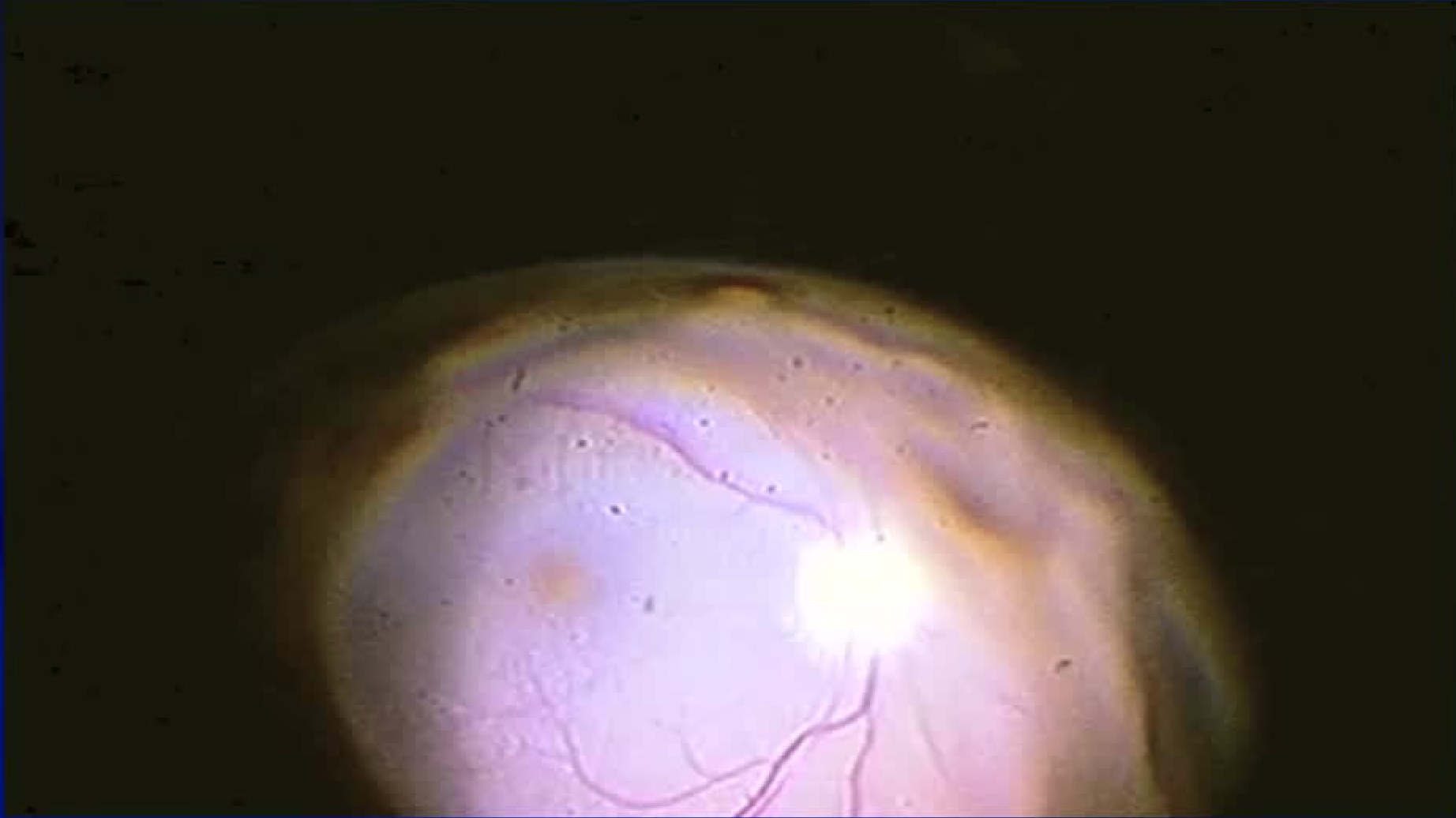 Poor Perfusion - Eyetube