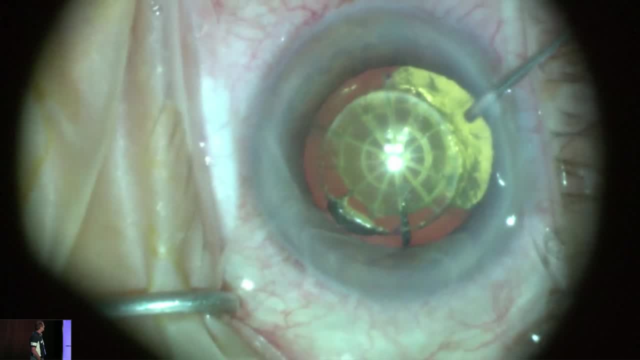 Toric IOL Placement With LENSAR IntelliAxis - Eyetube