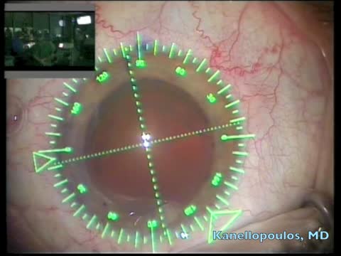 Verion Assisted Toric IOL Implantation - Eyetube