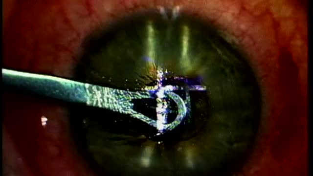 KAMRA Inlay Procedure - Eyetube