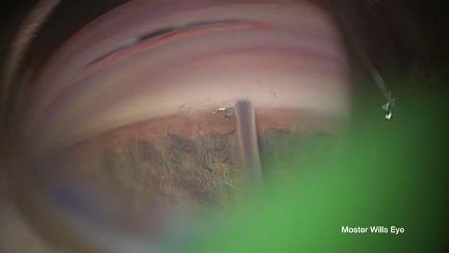 New Technique for iStent Insertion - Eyetube