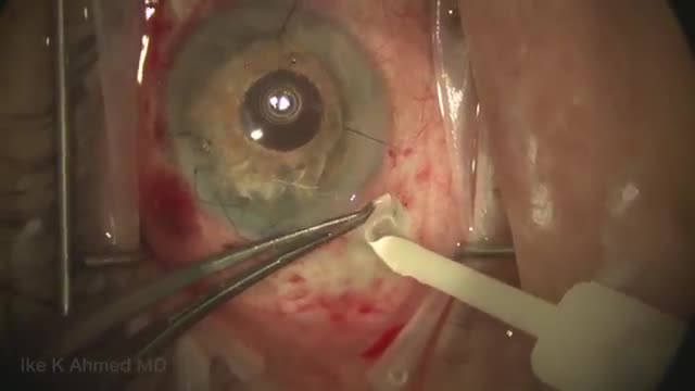 Sutureless Customized Iris Prosthesis and Intraocular Lens Fixation ...