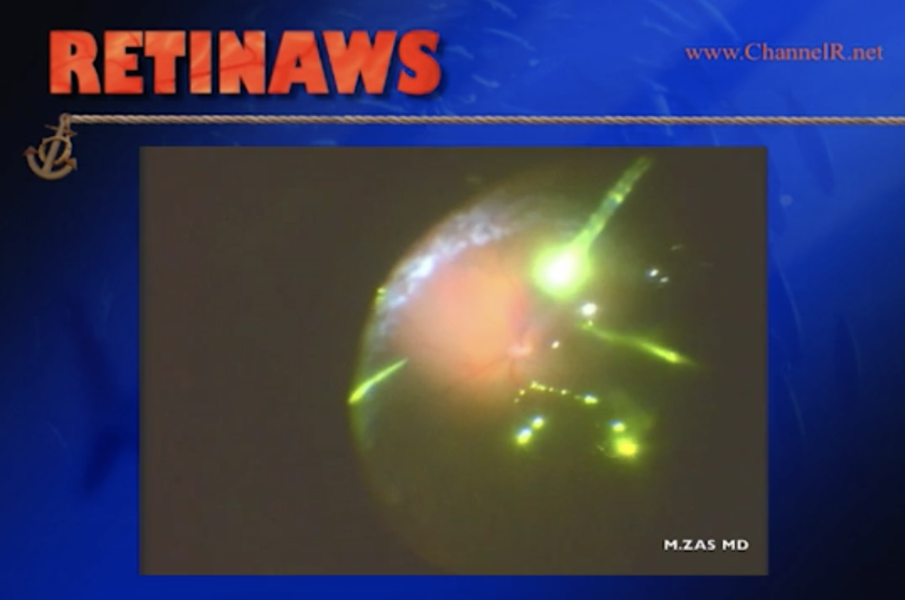 PVR & Subretinal Hemorrhage - Eyetube