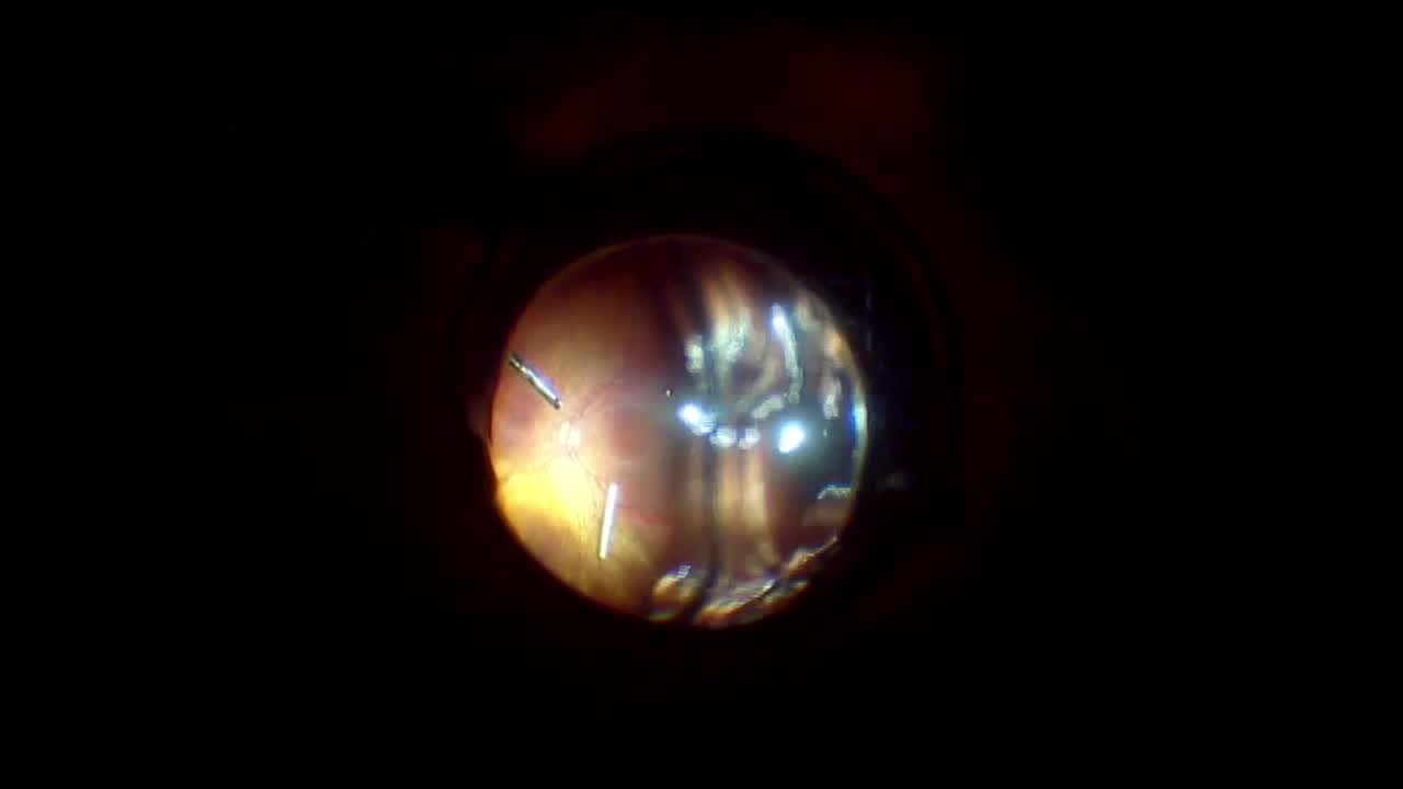 Ozurdex in PVR Following Retinal Detachment - Eyetube