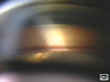 Corneal Wedge in Normal Angle - Eyetube