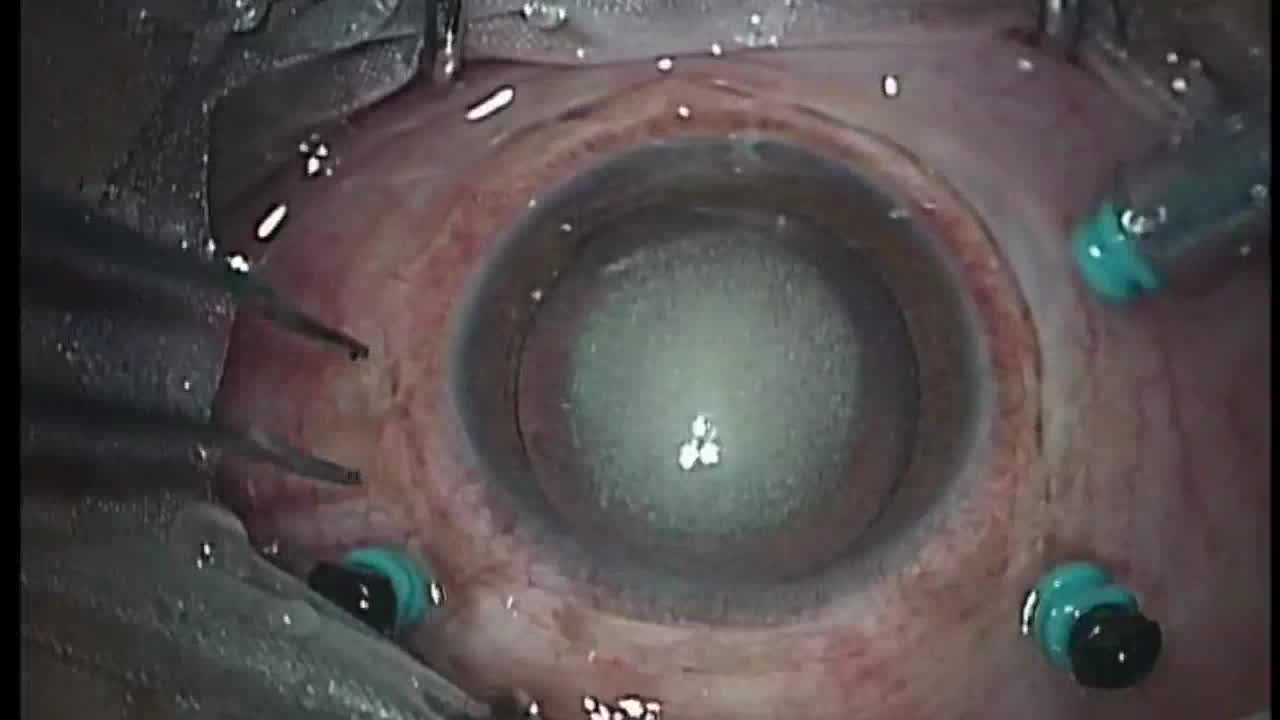 Removal of Large Hyperoleon - Eyetube