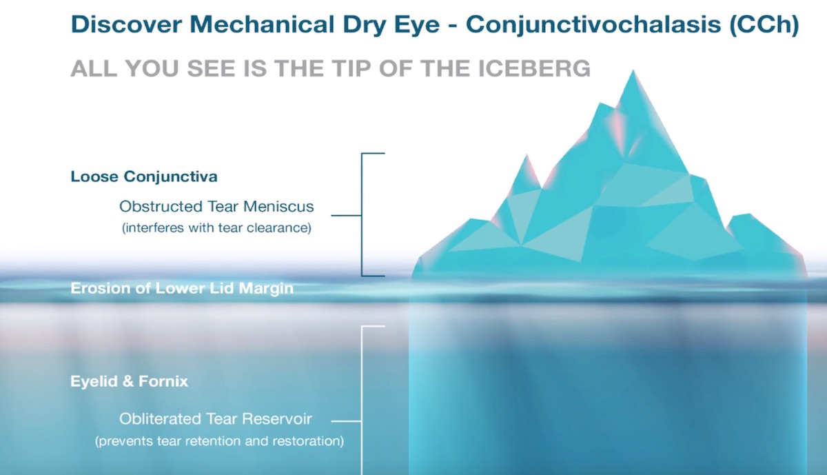 Understanding the CCh Anatomy - Eyetube