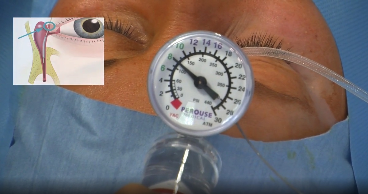 Ophtacath® | Lacrimal Duct Balloon Catheter | DCP procedure - Eyetube