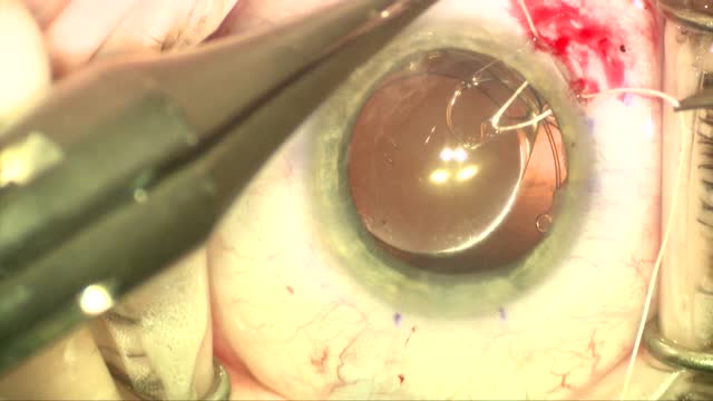 Femtosecond Laser Assisted Subluxed Lens Removal with Toric IOL ...