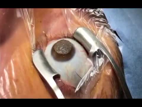 New Corneal Epithelial Peeling Technique for Refractive ASA - Eyetube