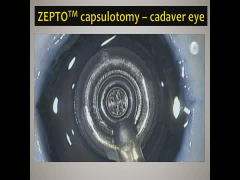 Nanopulse Capsulotomy - Zepto System - Eyetube
