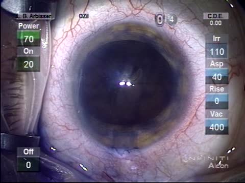 Bilateral Simultaneous Brunescent PCCC Optic Capture: Part 1 - Eyetube