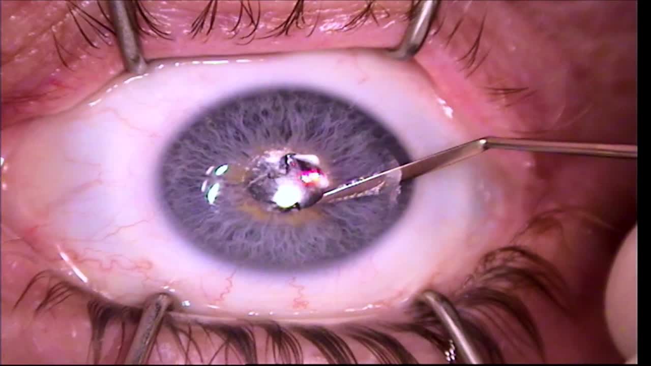 Kamra Inlay Explant - Eyetube