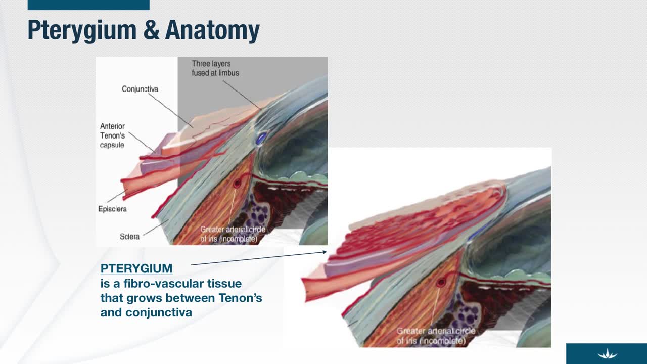 Pearls for Pterygium Surgery - Eyetube
