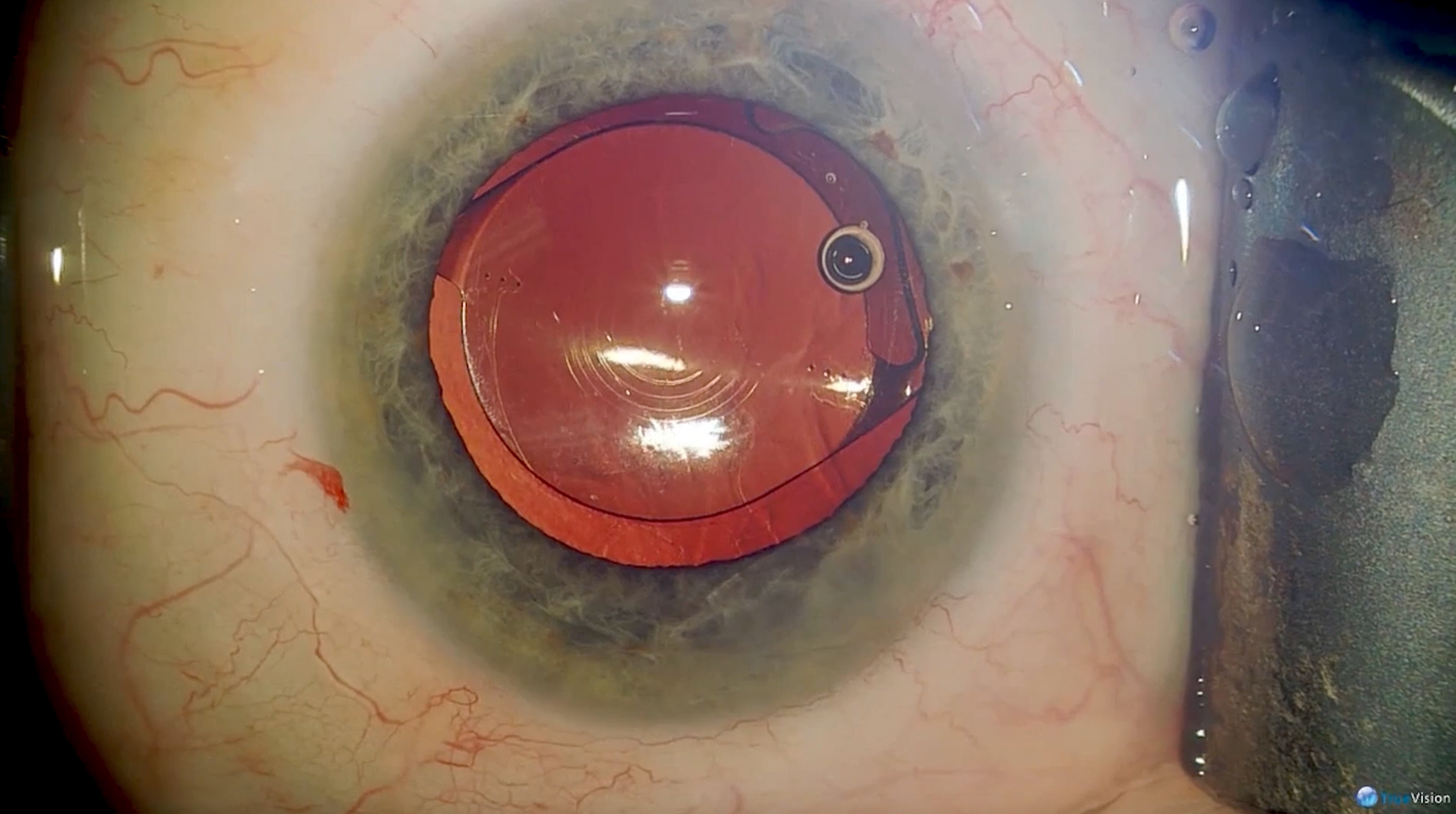 Elevating Toric IOL Procedures with the LENSAR® Laser - Eyetube