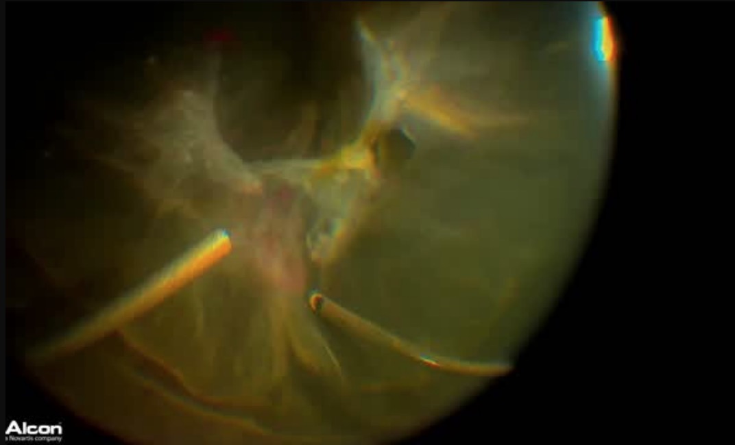 Ngenuity Version 1.2 - Eyetube