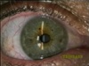 Intraocular Parasites - Part 1 - Eyetube