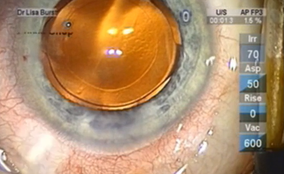 OVD Irrigated From the Clear Corneal Incision - Eyetube