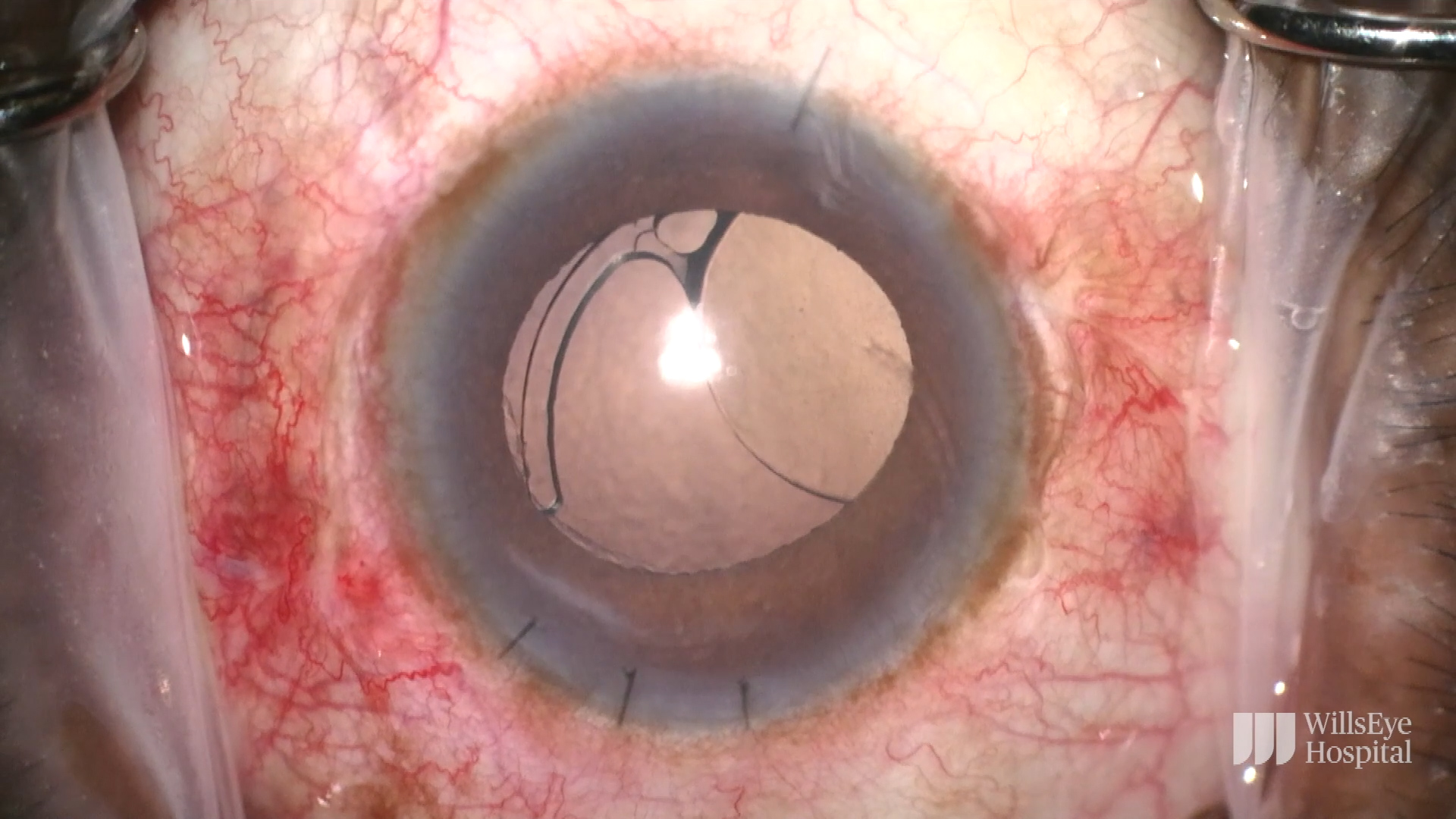 Managing a Torn and Dislocated IOL - Eyetube