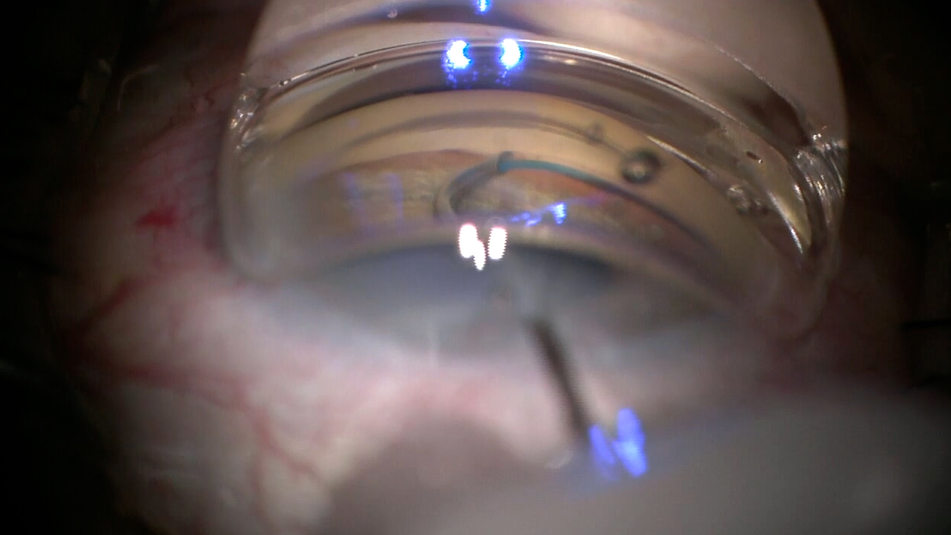 MIGS and Match: Combining Procedures for Optimal Effect - Eyetube