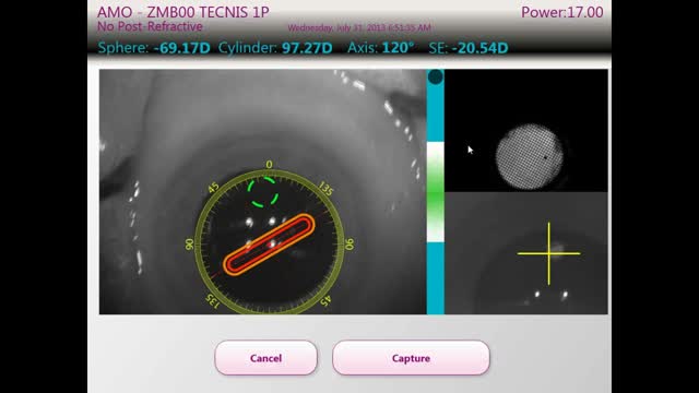Real Time Aberrometry Guided LRI with ORA With Verifeye - Eyetube