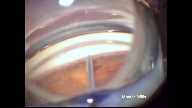 iStent Placement - Eyetube