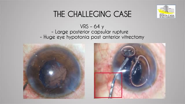 Vitreous Bubble: A New Approach to Posterior Capsular Rupture - Eyetube