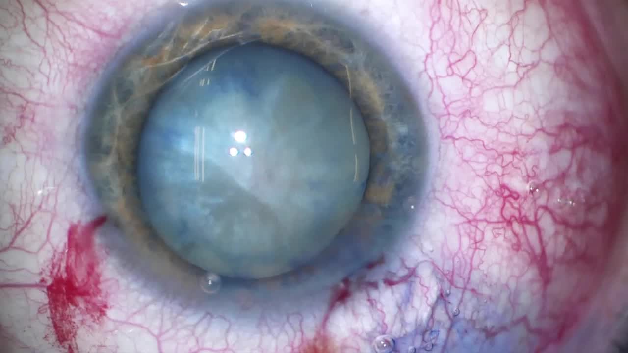 Spiral Rhexis - Eyetube