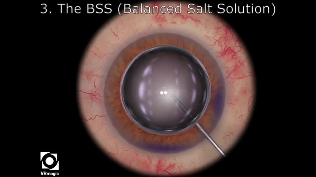 EyeSi CAT-D: White Cataract Capsulorhexis - Eyetube