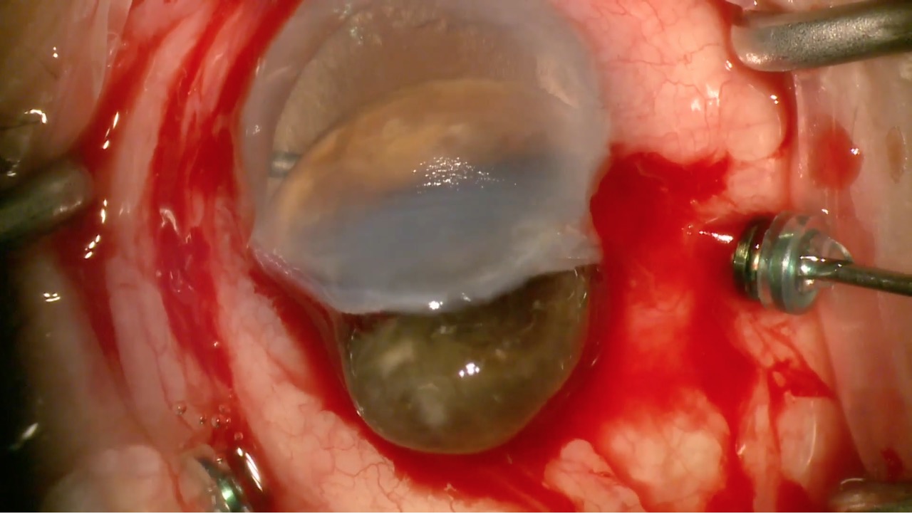 Old School Meets New School: ECCE to Glued IOL - Eyetube