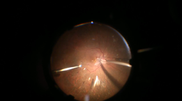 Diabetic Tractional Retinal Detachment With Dense ERM - Eyetube