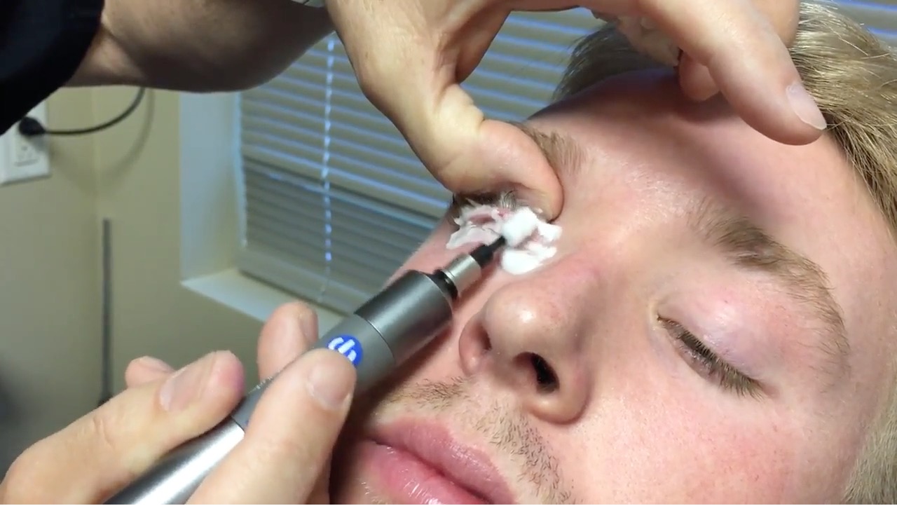 BlephEx Treatment Instruction Video - Eyetube