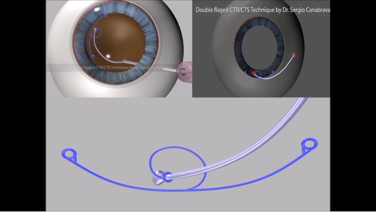 Canabrava Sutureless Technique - Eyetube