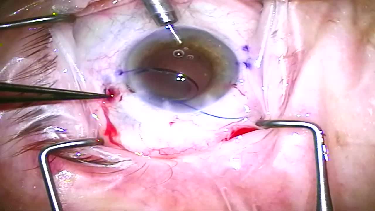 Flanged Haptic Scleral Fixation: Modified Yamane Technique - Eyetube
