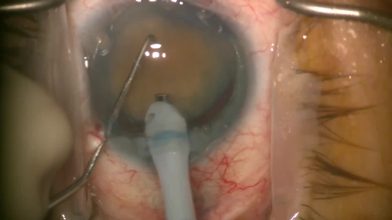 How to Disassemble a Morgagnian Cataract - Eyetube