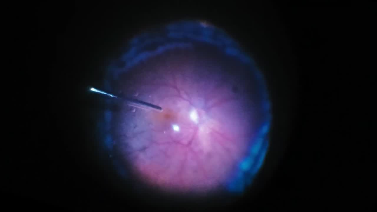 Vitrectomy for Severe PVR and Total Retinal Detachment - Eyetube