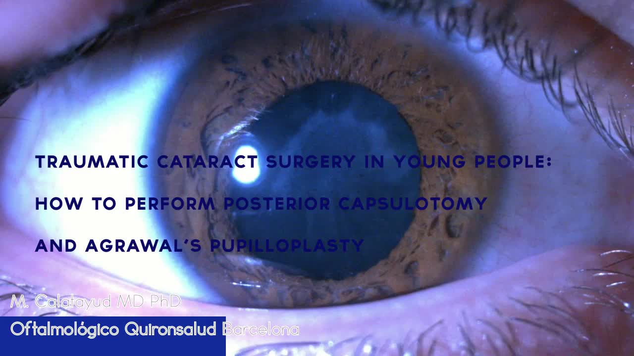 Traumatic Cataract Surgery and Agrawal's Pupilloplasty - Eyetube