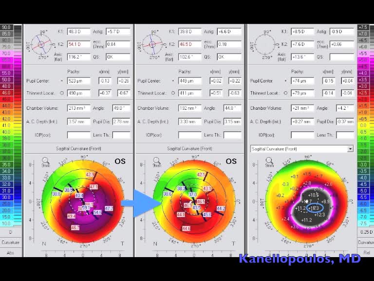 Modified Athens Protocol: Combined Technique for Keratoconus - Eyetube
