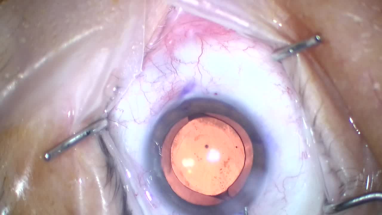 Dexycu Injection - Eyetube