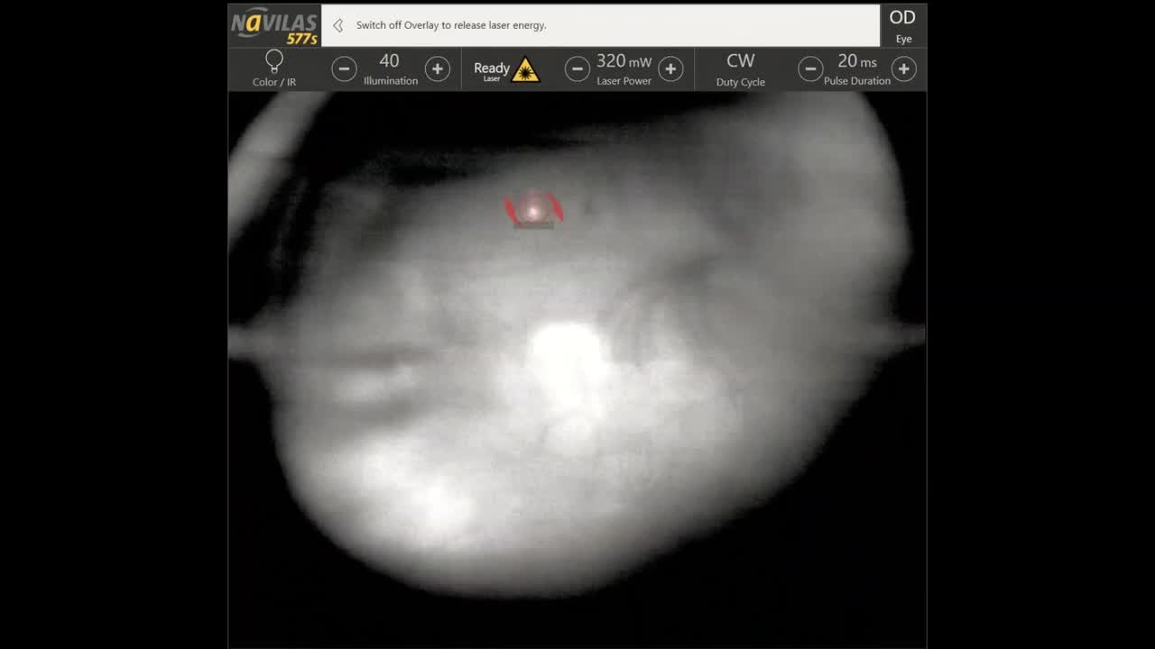 Noncontact Navigated Laser Photocoagulation of a Retinal Tear - Eyetube