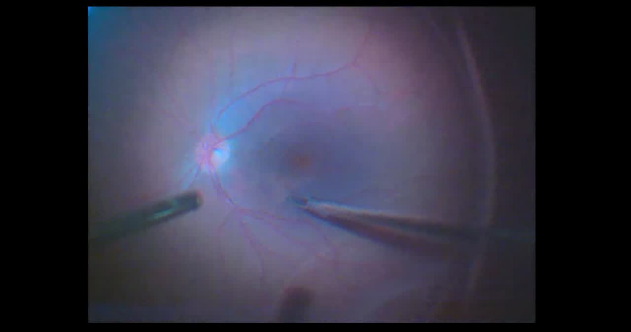 Alcon Ngenuity 3D Ultra Magnification Mode - Eyetube