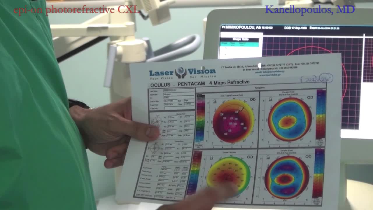 Custom Topography Tutorial for Refractive Cross Linking - Eyetube